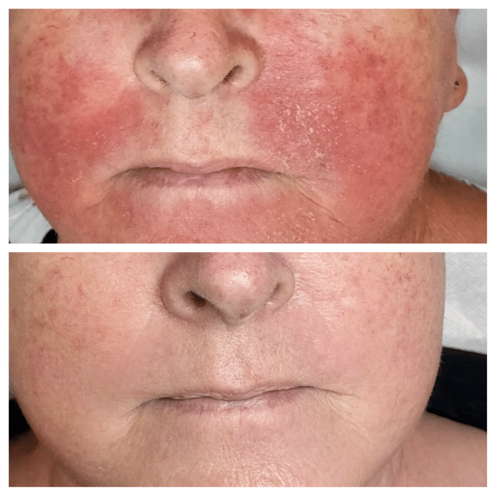 Hvad er eksem/ atopisk eksem. Hvordan behandles hudlidelsen?