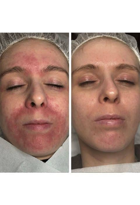 Hvad er Perioral dermatitis og hvordan behandles hudlidelsen